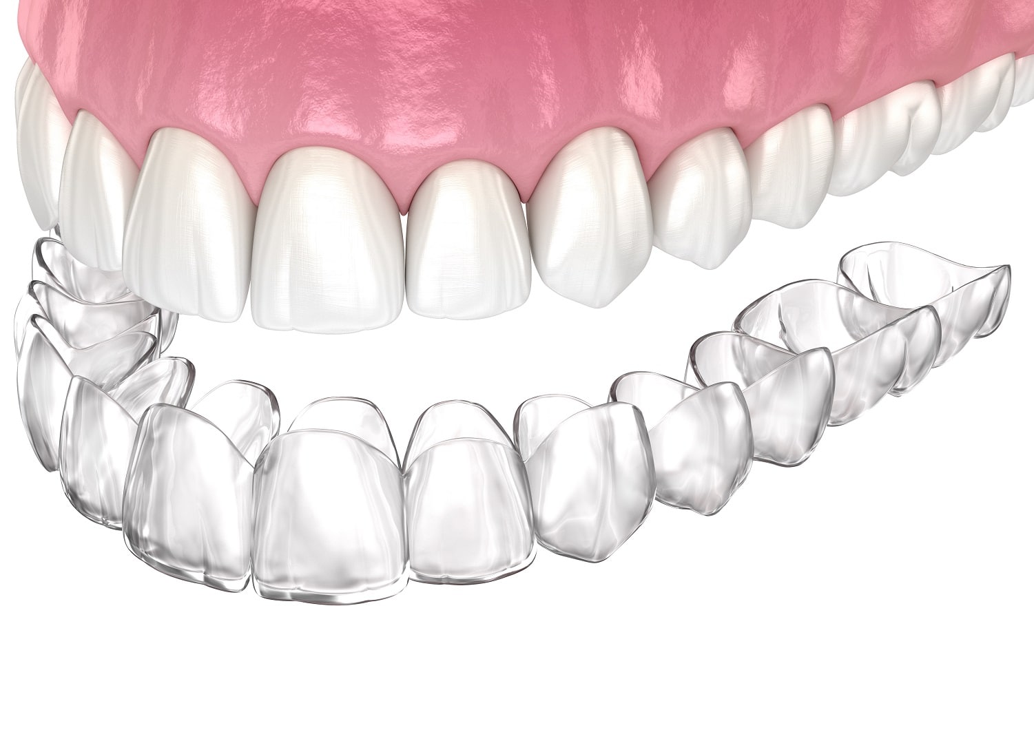 The Value in Invisalign® Orthodontic Aligners | Pella, IA